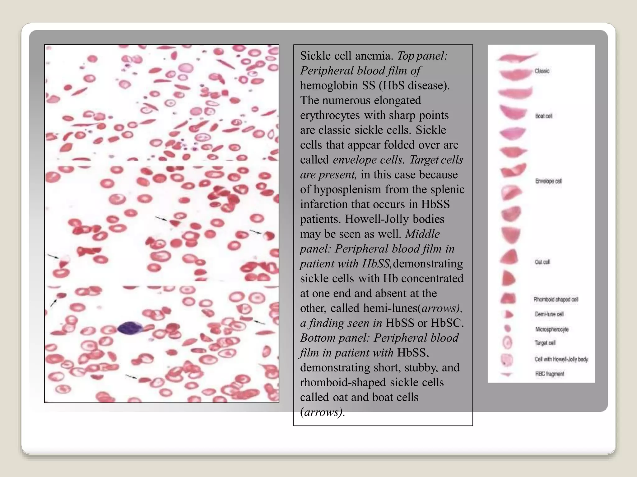 Hemolytic anemia | PDF