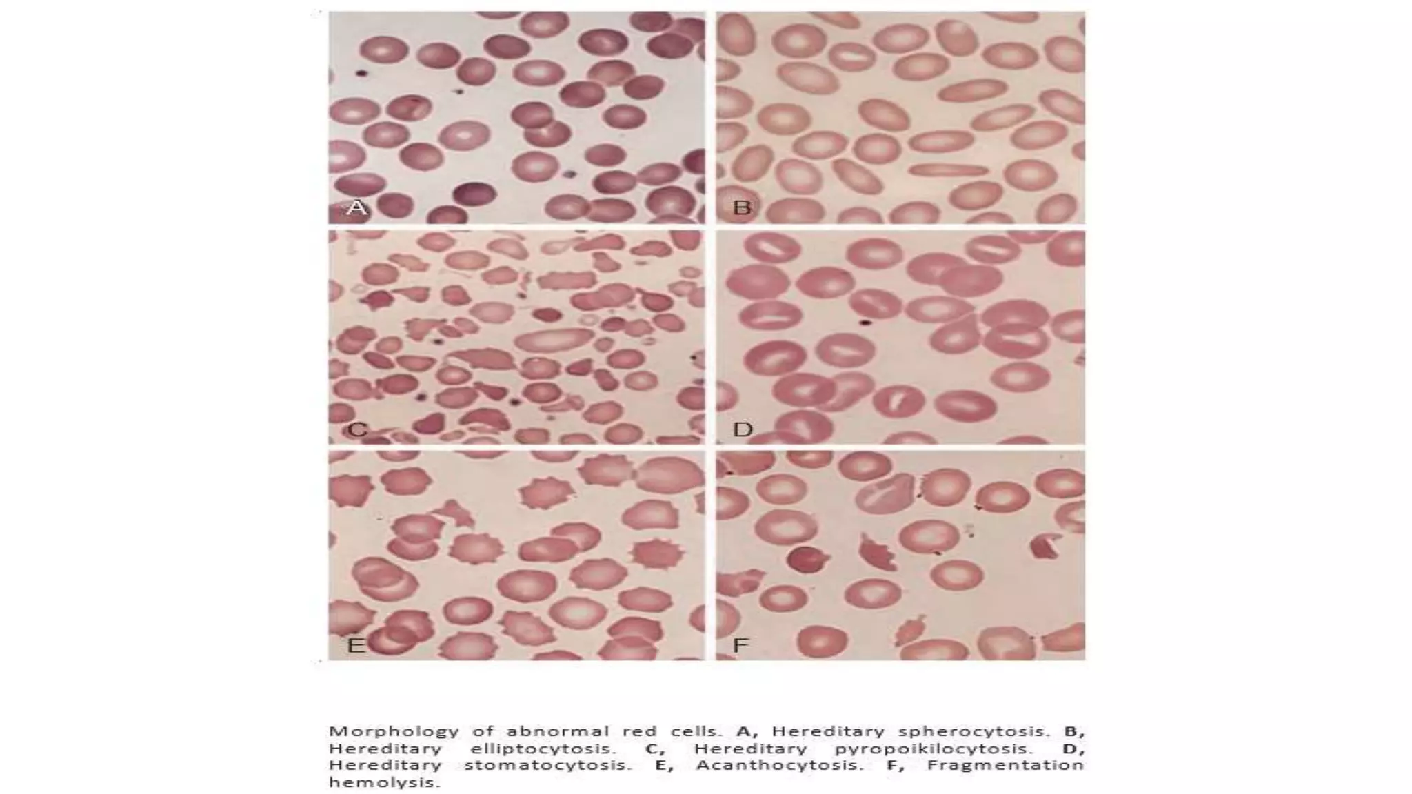 Hemolytic anemia.pptx