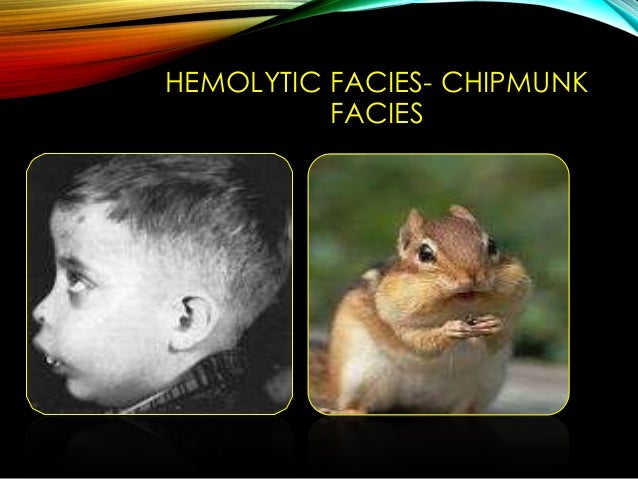 Hemolyticanemia afnan