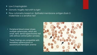 HEMOLYTIC ANEMIA -including autoimmine hemolytic anemia.pptx