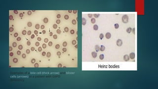 HEMOLYTIC ANEMIA -including autoimmine hemolytic anemia.pptx