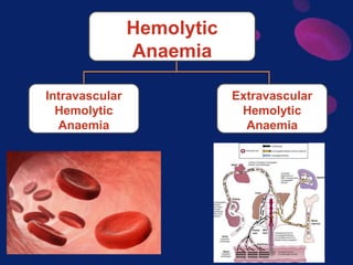 Hemolytic Anemia - Dr. Julius King Kwedhi - Pediatrics | PPT