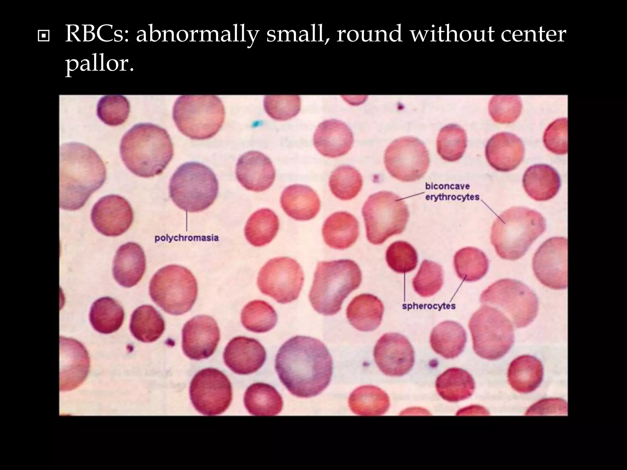 Hemolytic anemia (1) | PPTX