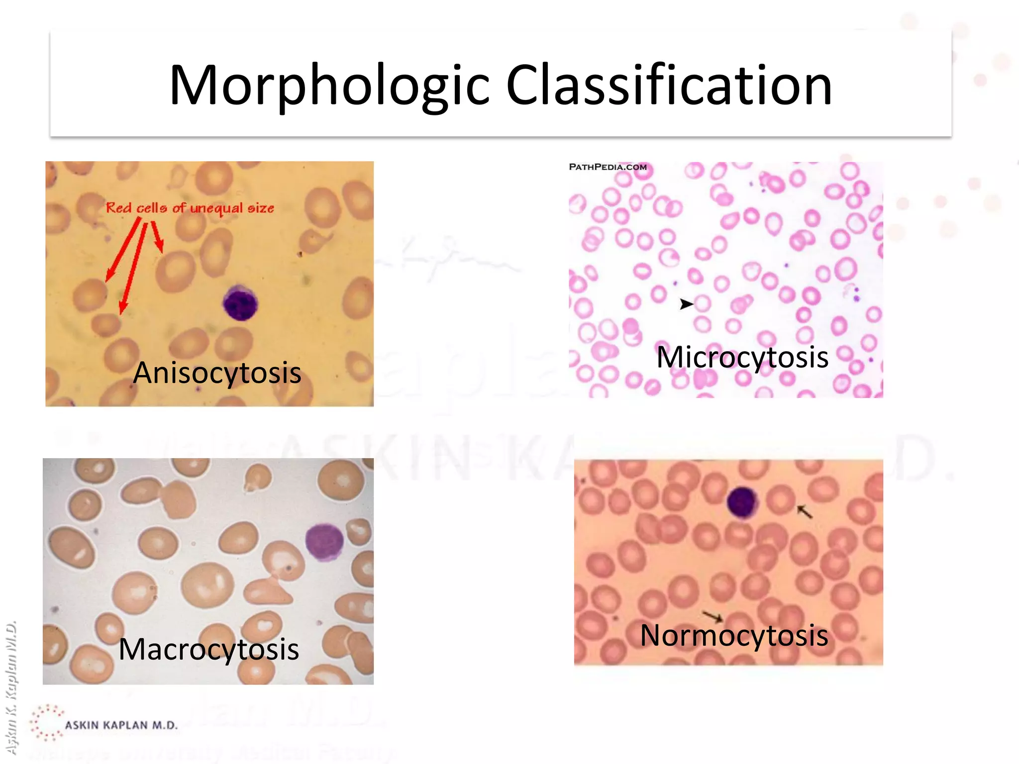 Hemolytic anemia akk | PDF