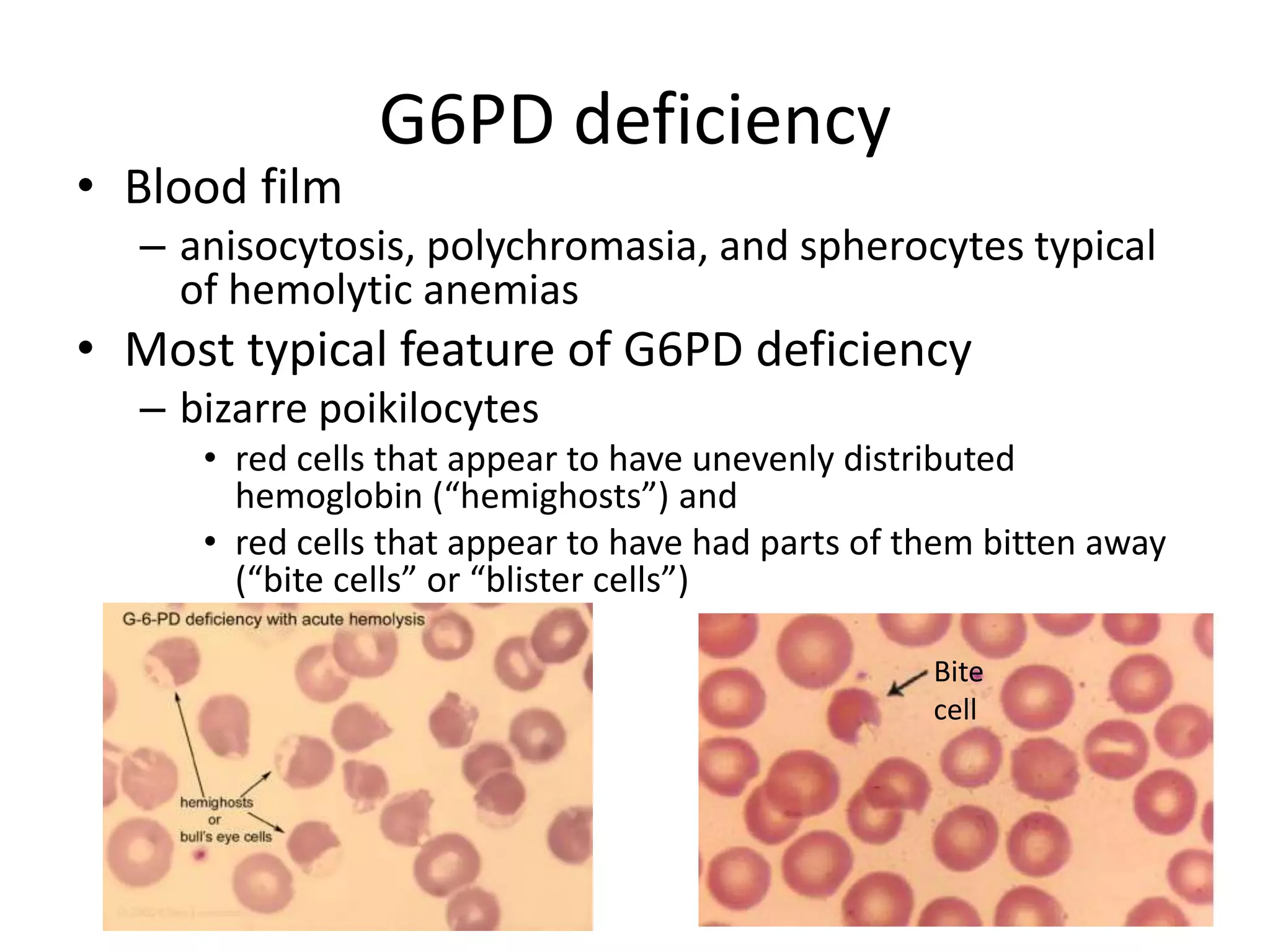 Hemolytic anemia case | PPTX
