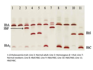 Hemolytic anemia HPLC new good one .pptx