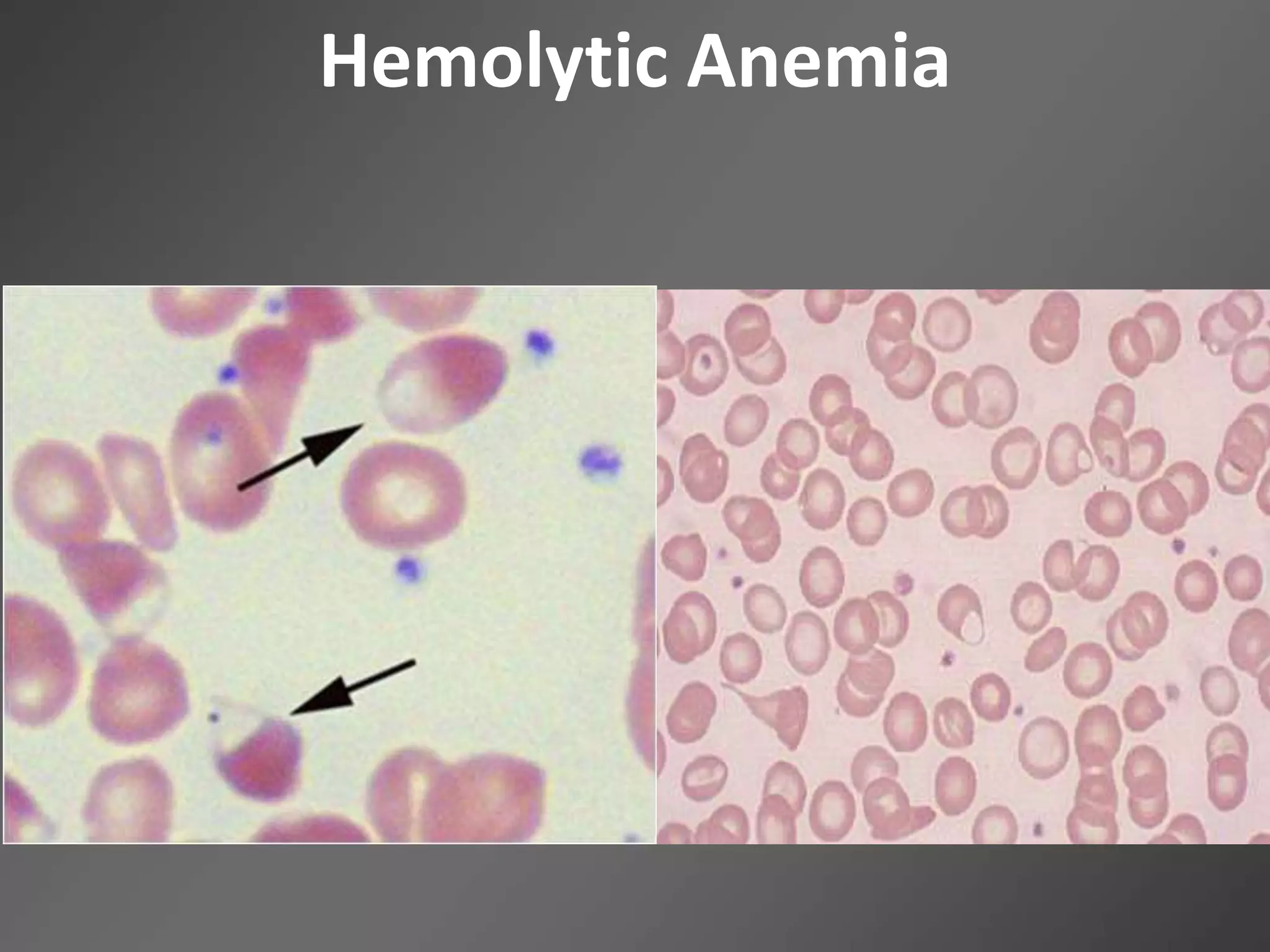 Hemolytic anemia I | PPTX