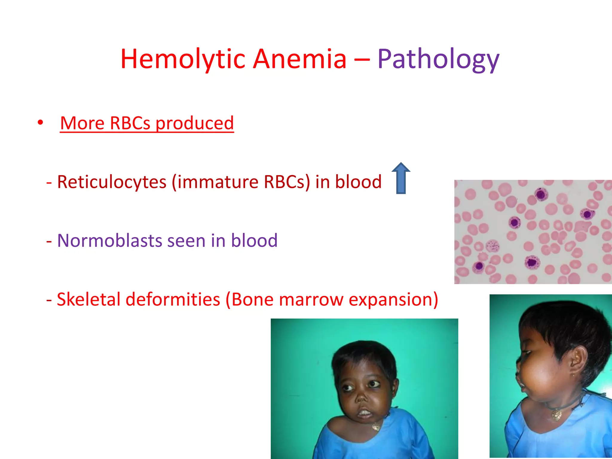 Hemolytic anemia in children 2021 | PDF