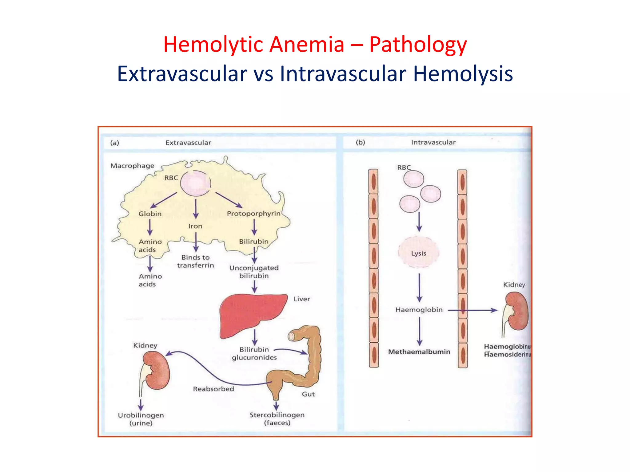 Hemolytic anemia in children 2021 | PDF