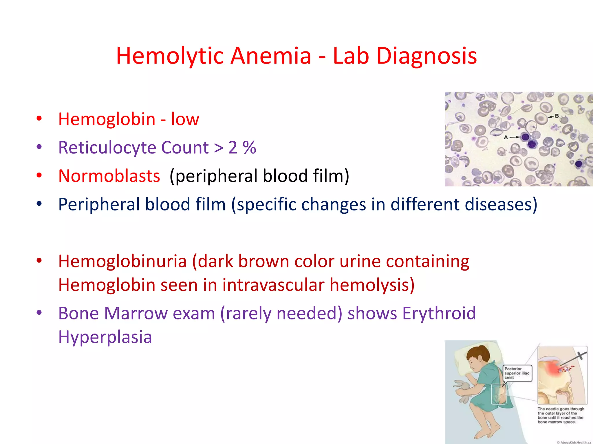 Hemolytic anemia in children 2021 | PDF