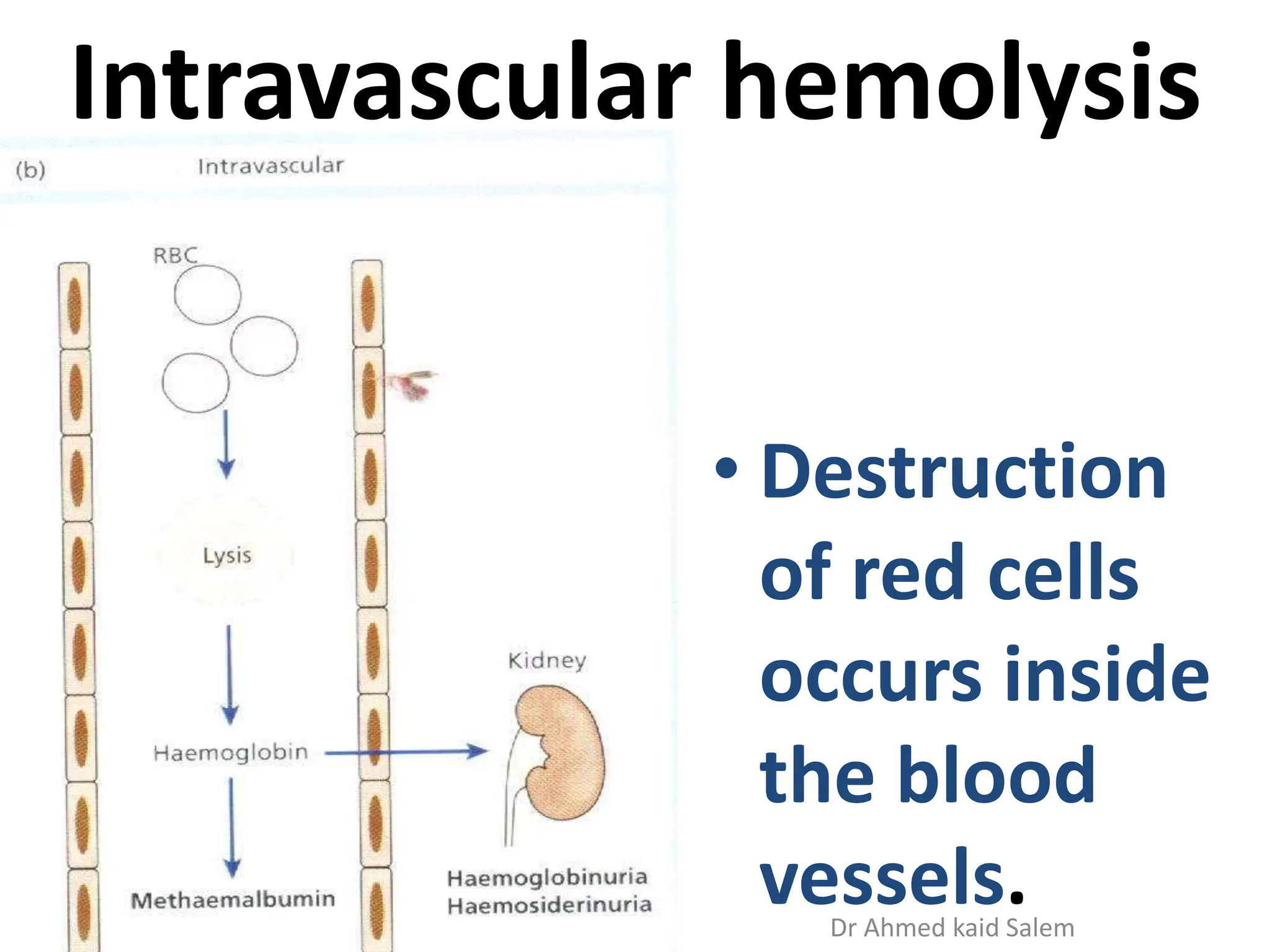 Hemolytic Anemias DDDDDDAIHA 2024 EU.ppt