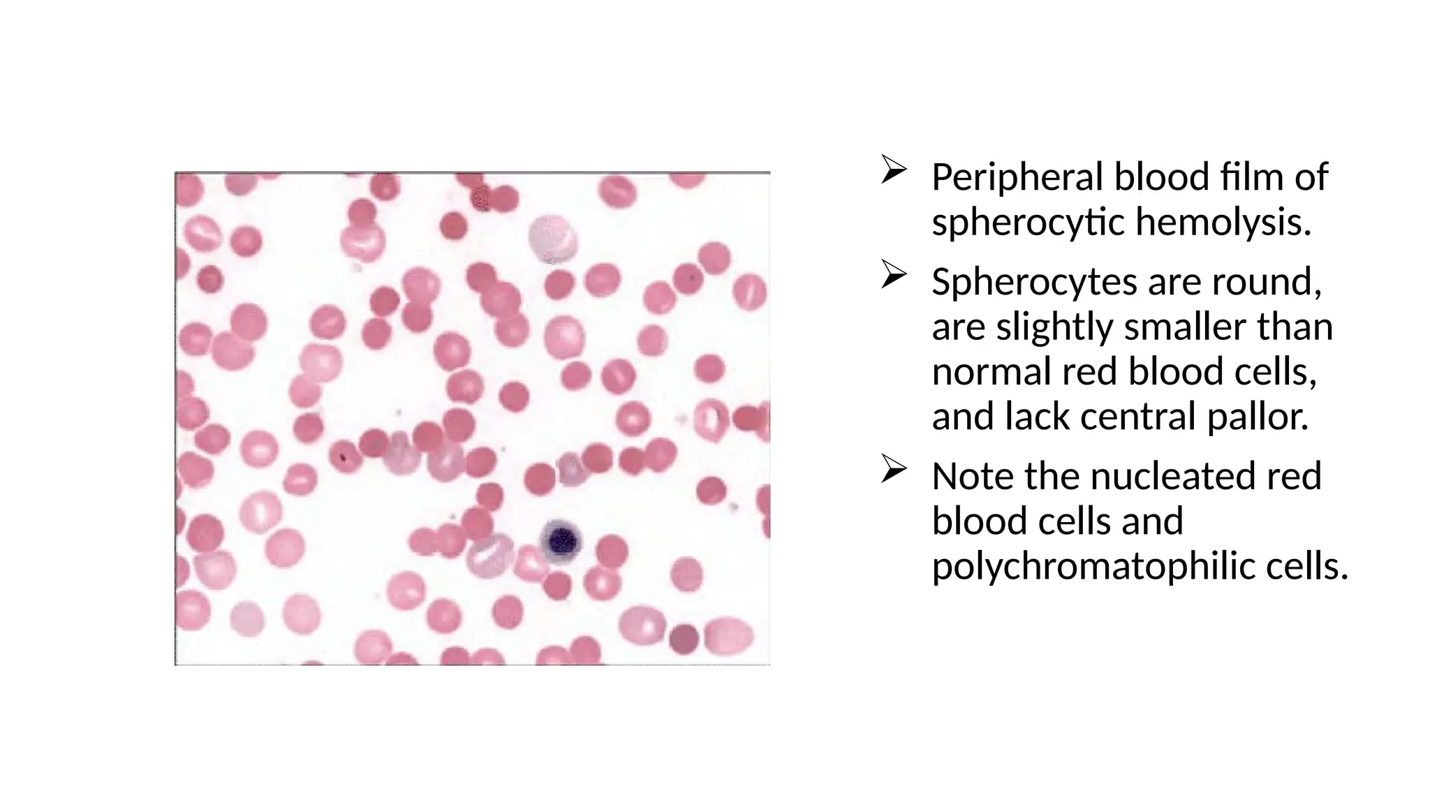 Hemolytic disorders due to Inherited abnormalities in Red cell ...