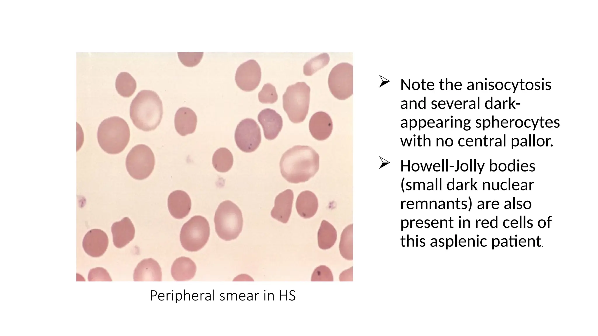 Hemolytic disorders due to Inherited abnormalities in Red cell ...
