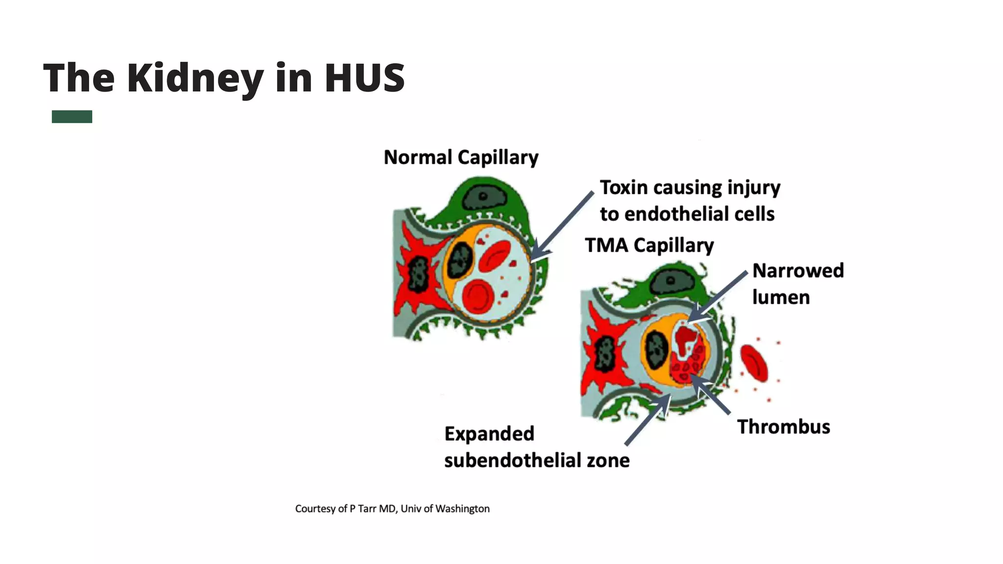 Hemolytic Uremic Syndrome (HUS) chris edits 7.31.23.pptx