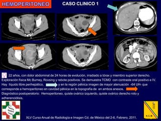 Hemoperitoneo | PDF