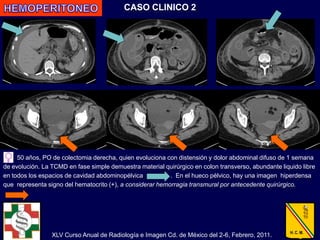 Hemoperitoneo | PDF