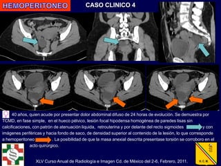 Hemoperitoneo | PDF