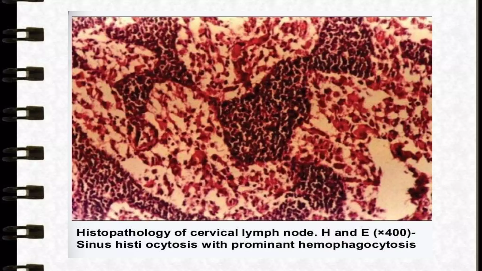 Hemophagocytic lymphohistiocytosis (hlh), Langerhans cell histiocytosis ...