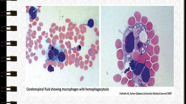 Hemophagocytic lymphohistiocytosis (hlh), Langerhans cell histiocytosis ...