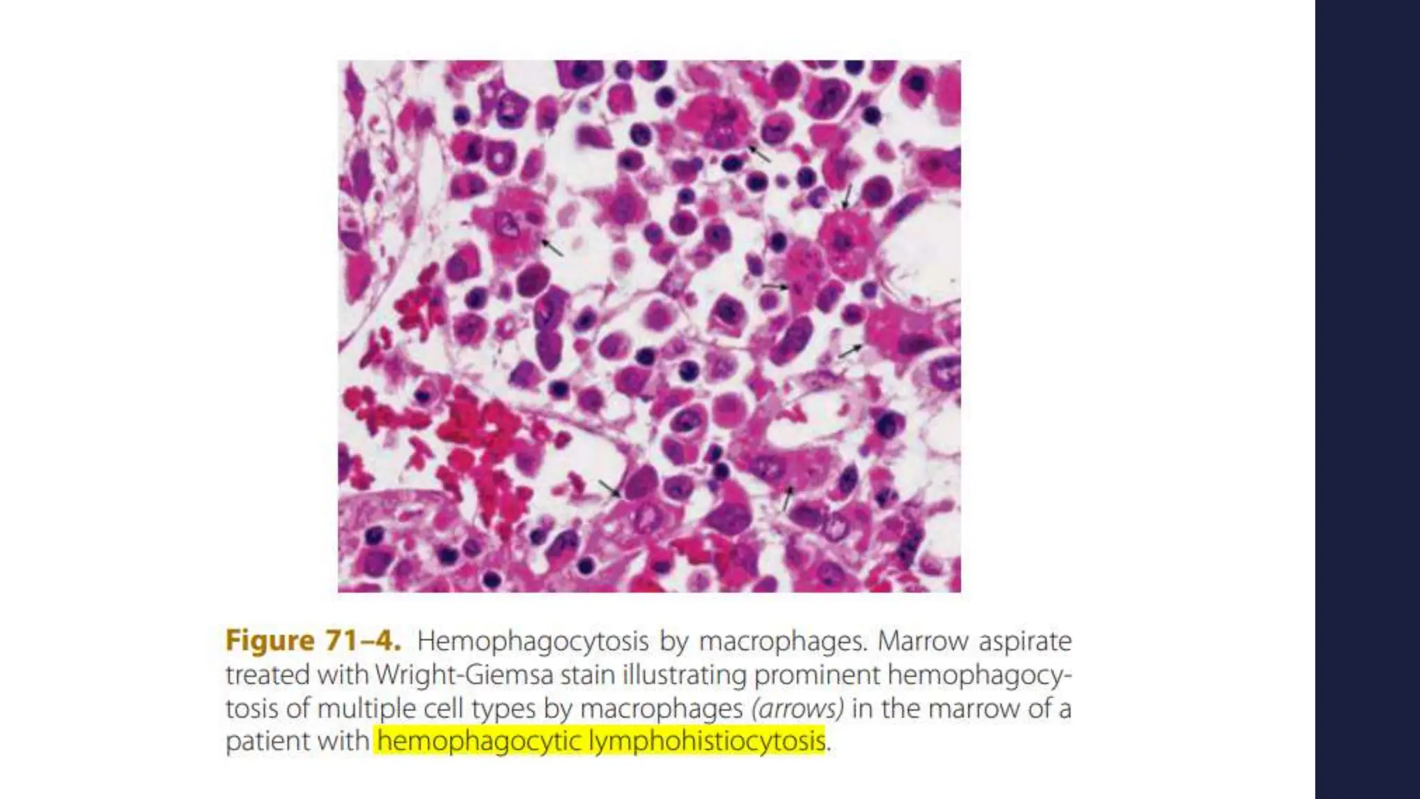 Hemophagocytic Lymphohistiocytosis (HLH) | PPTX