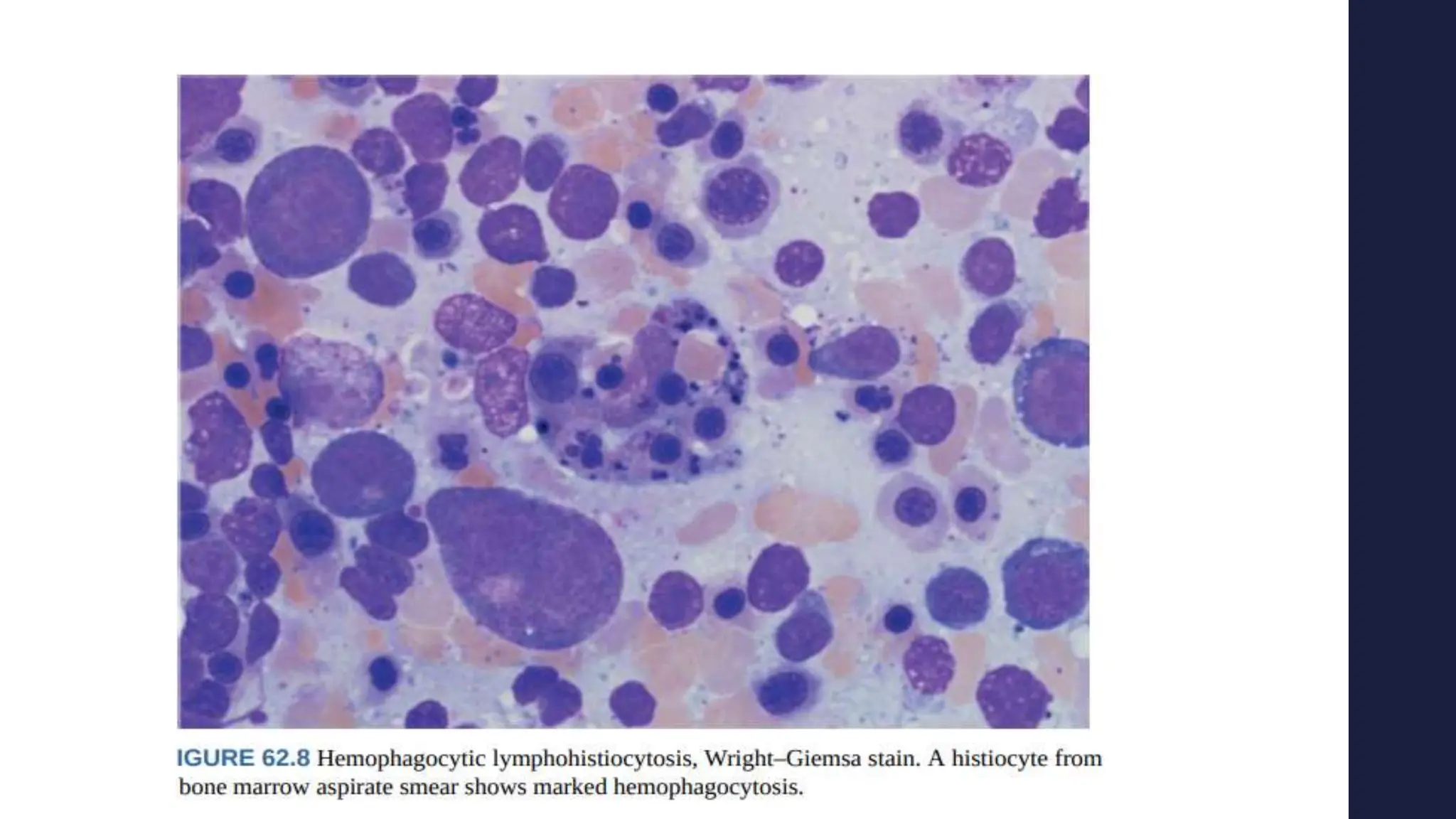 Hemophagocytic Lymphohistiocytosis (HLH) | PPTX
