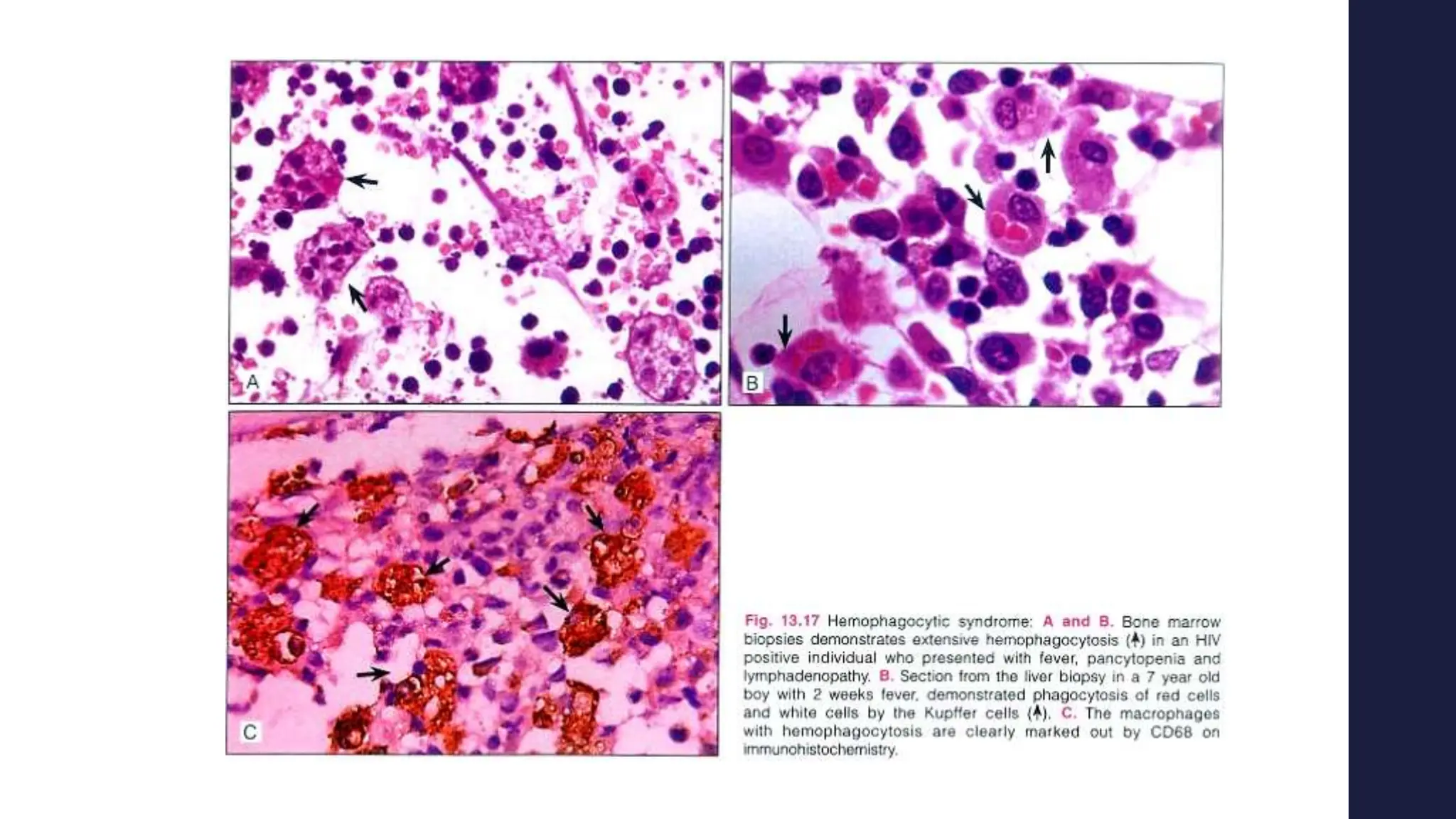Hemophagocytic Lymphohistiocytosis (HLH) | PPTX