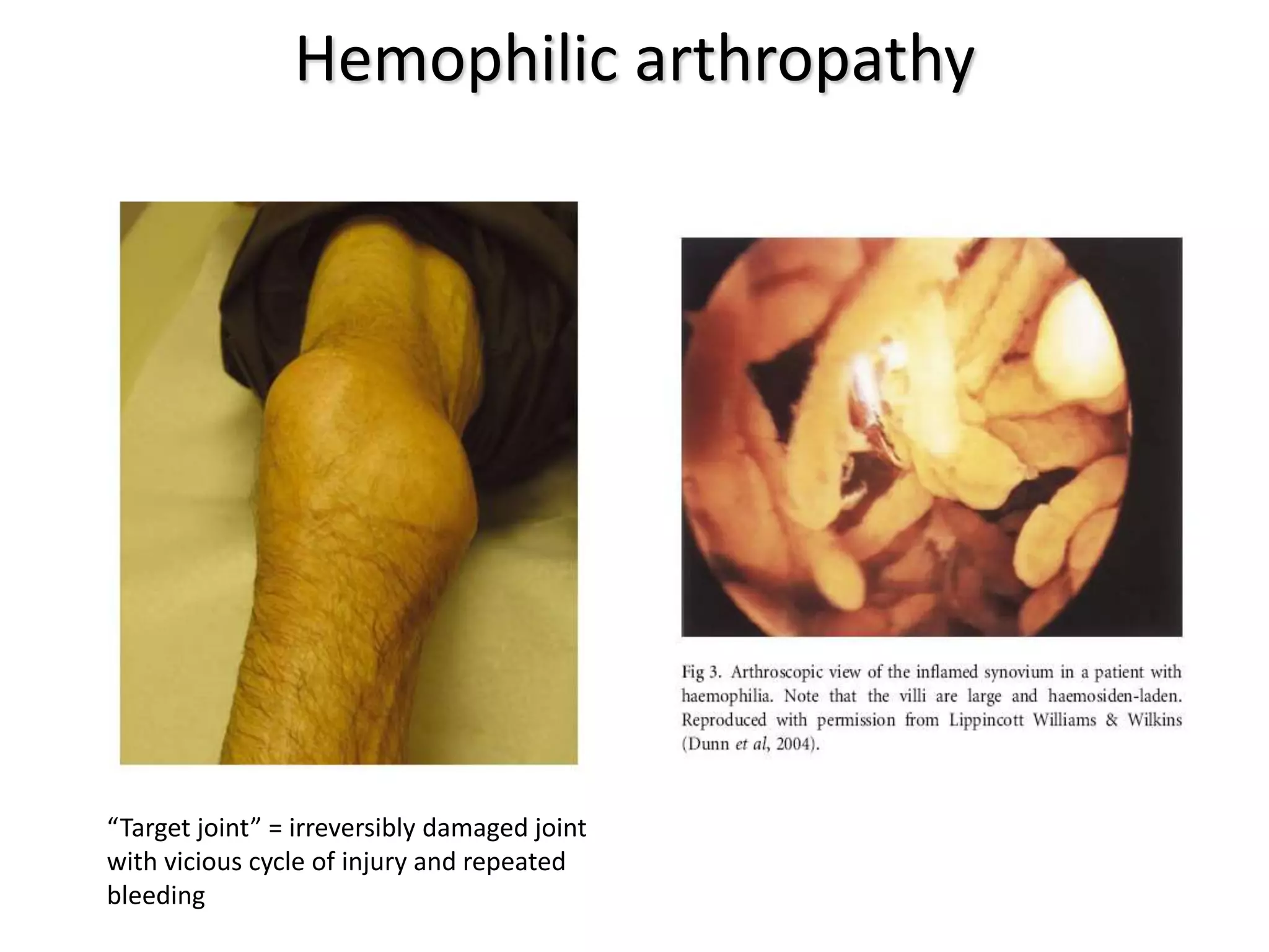 Hemophila | PPTX