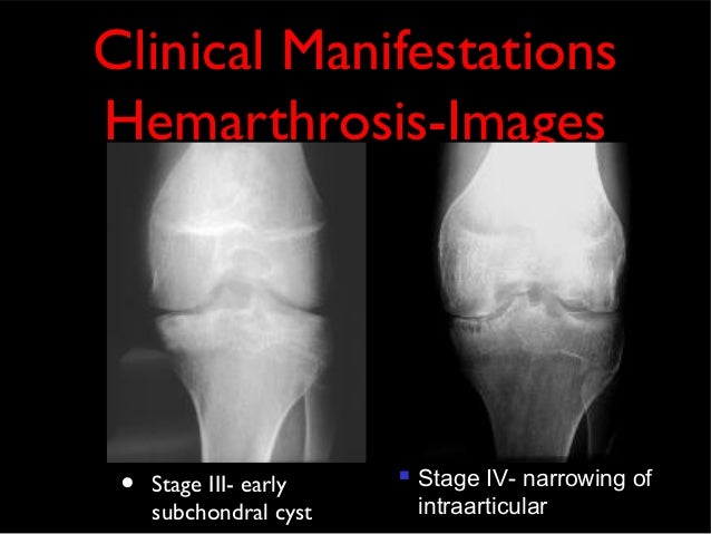 Hemarthrosis