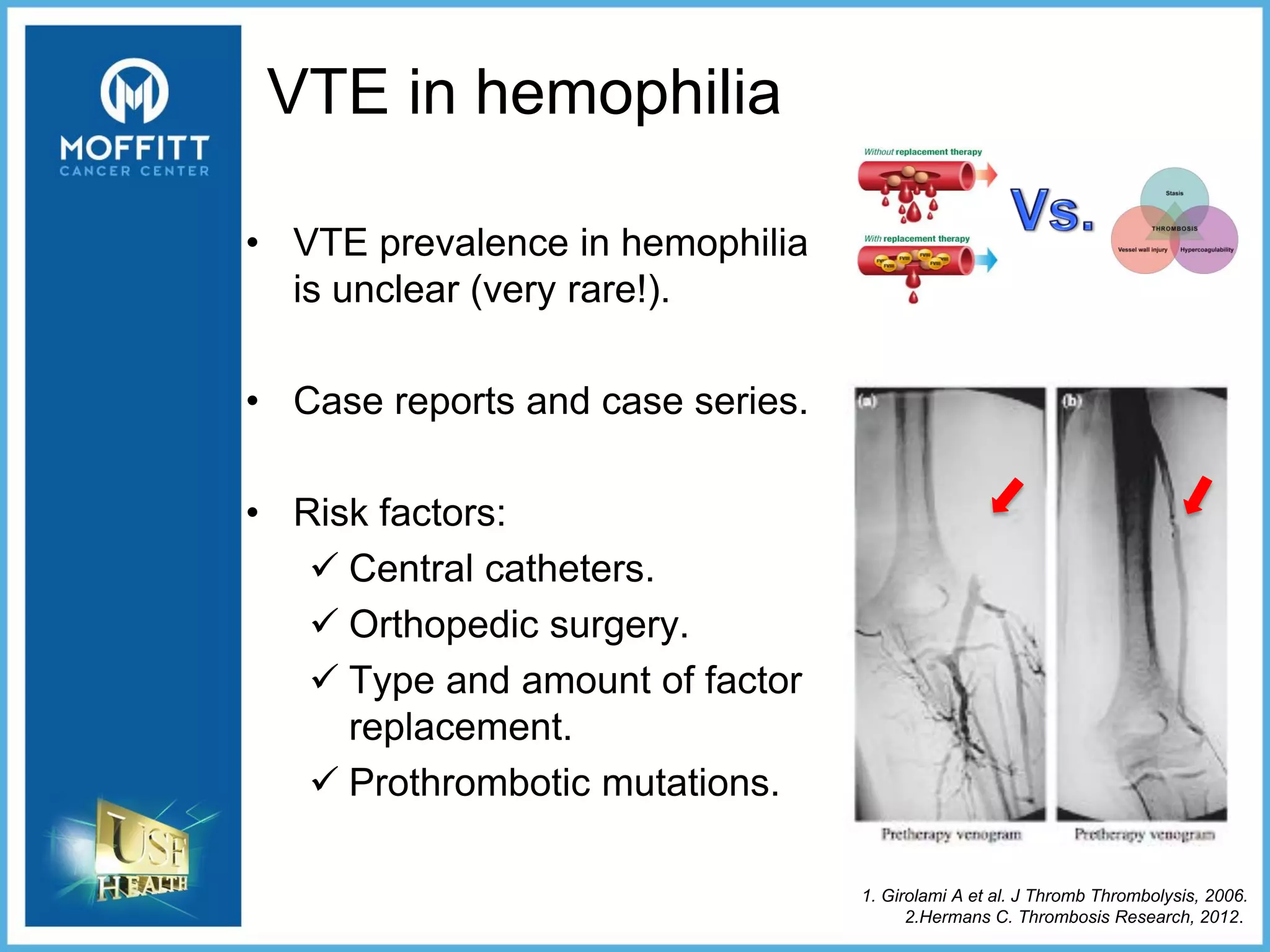 Hemophilia Case Study | PDF