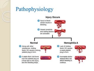 Hemophilia ppt lakshmi | PPT