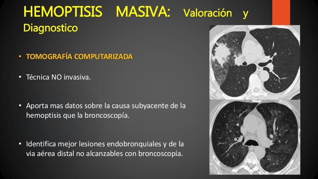 Hemoptisis masiva y hemorragia alveolar