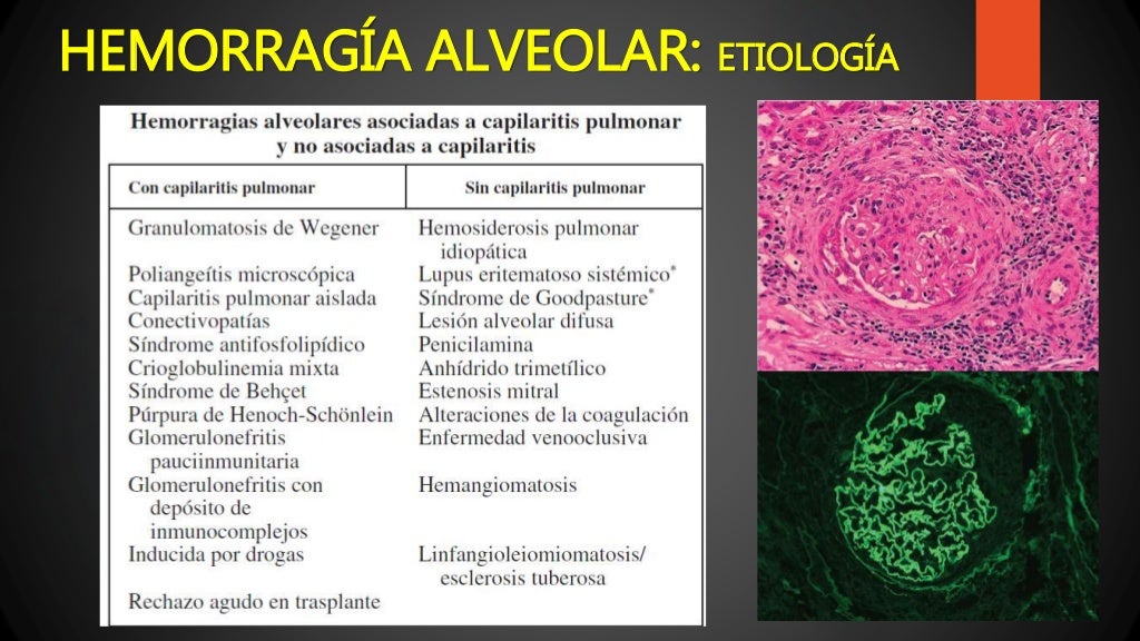 Hemoptisis masiva y hemorragia alveolar