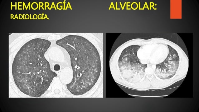 Hemoptisis masiva y hemorragia alveolar