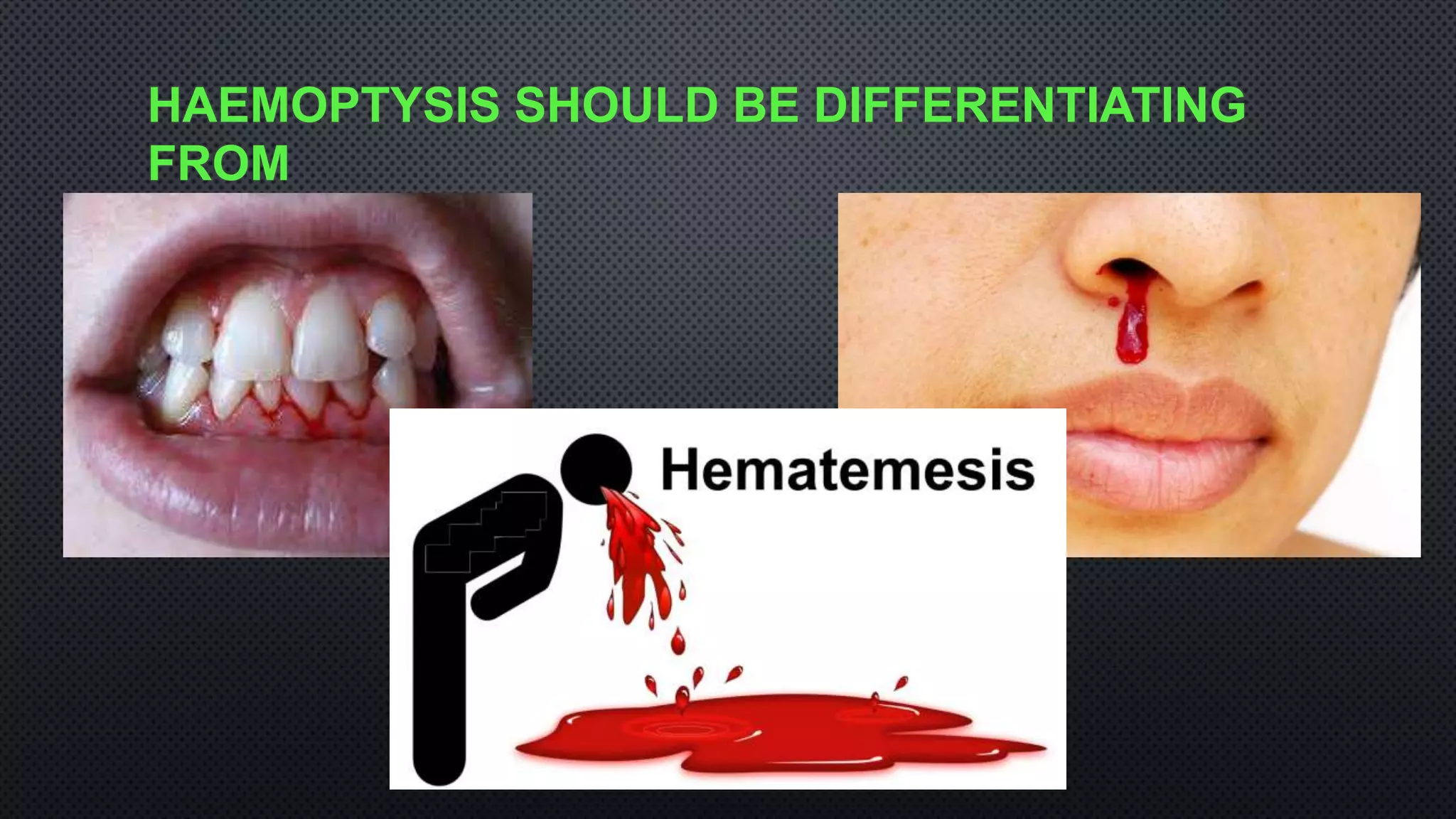 Hemoptysis and its management | PPTX