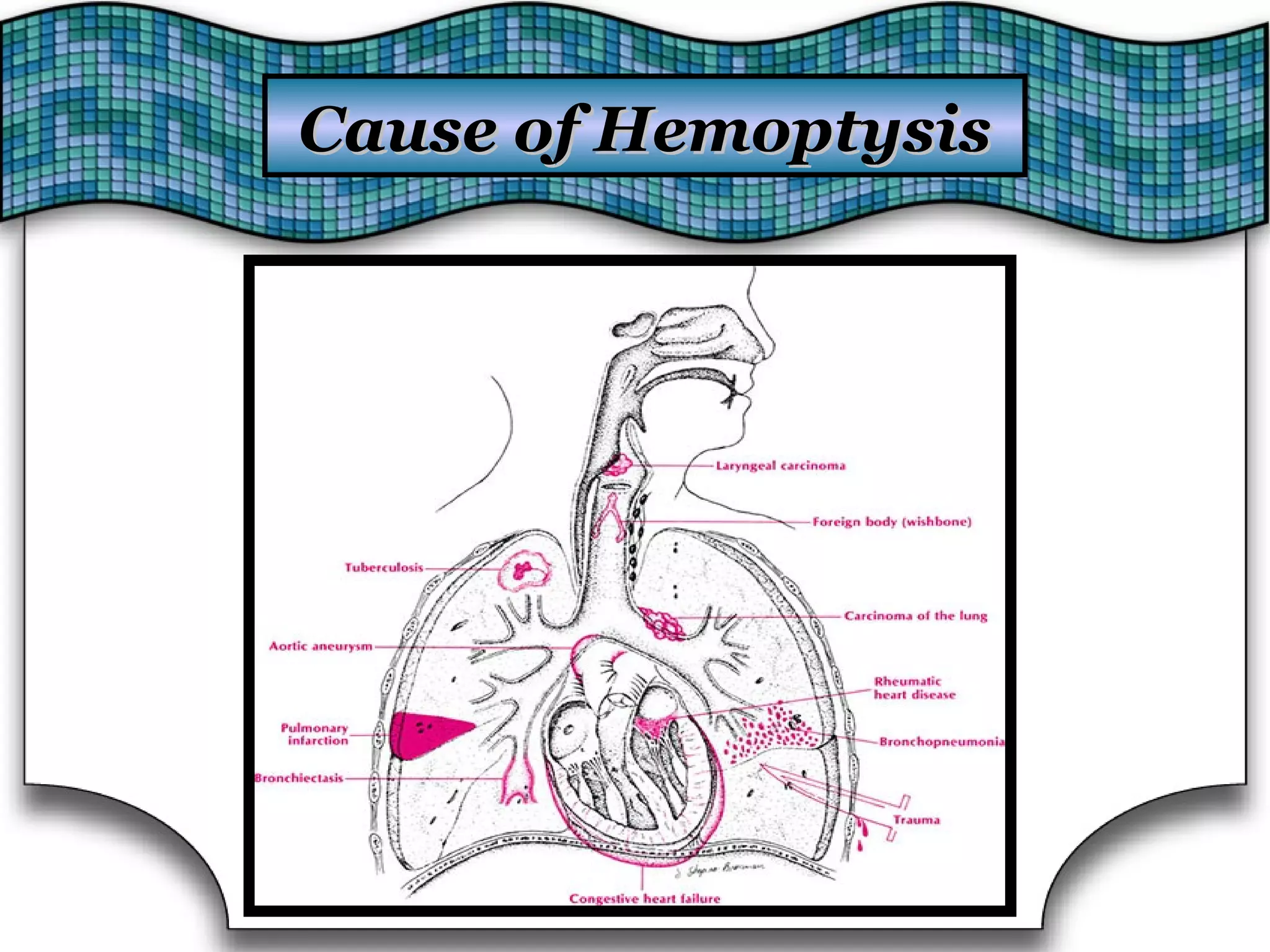 Hemoptysis | PPT