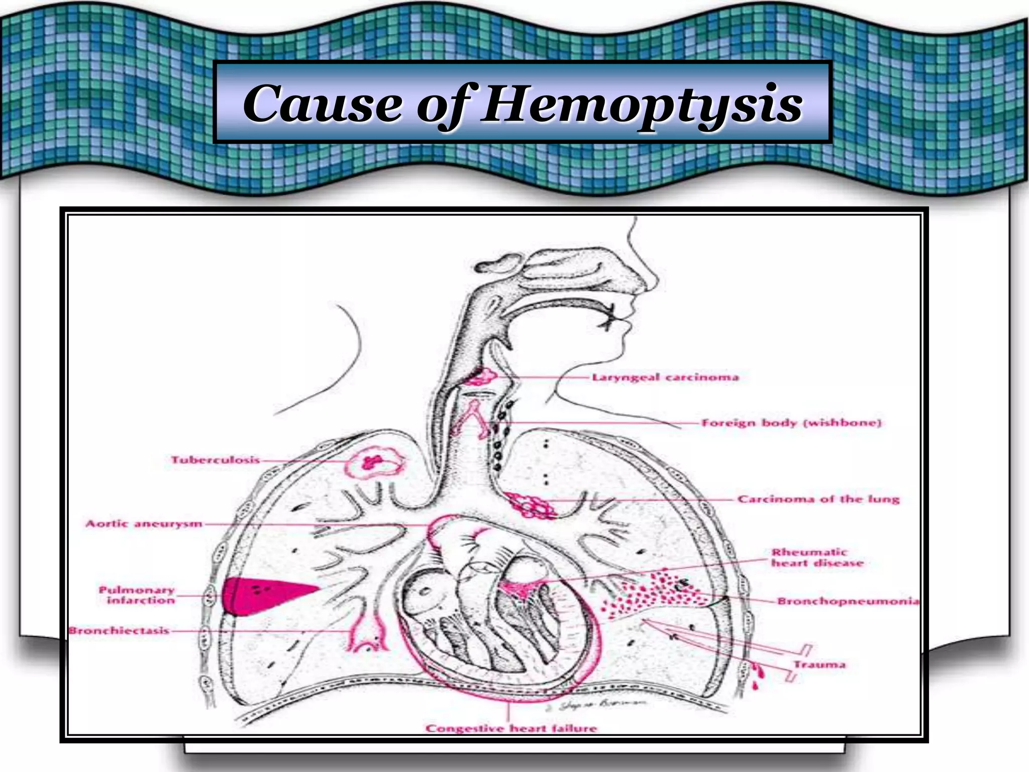 hemoptysispresentation.ppt