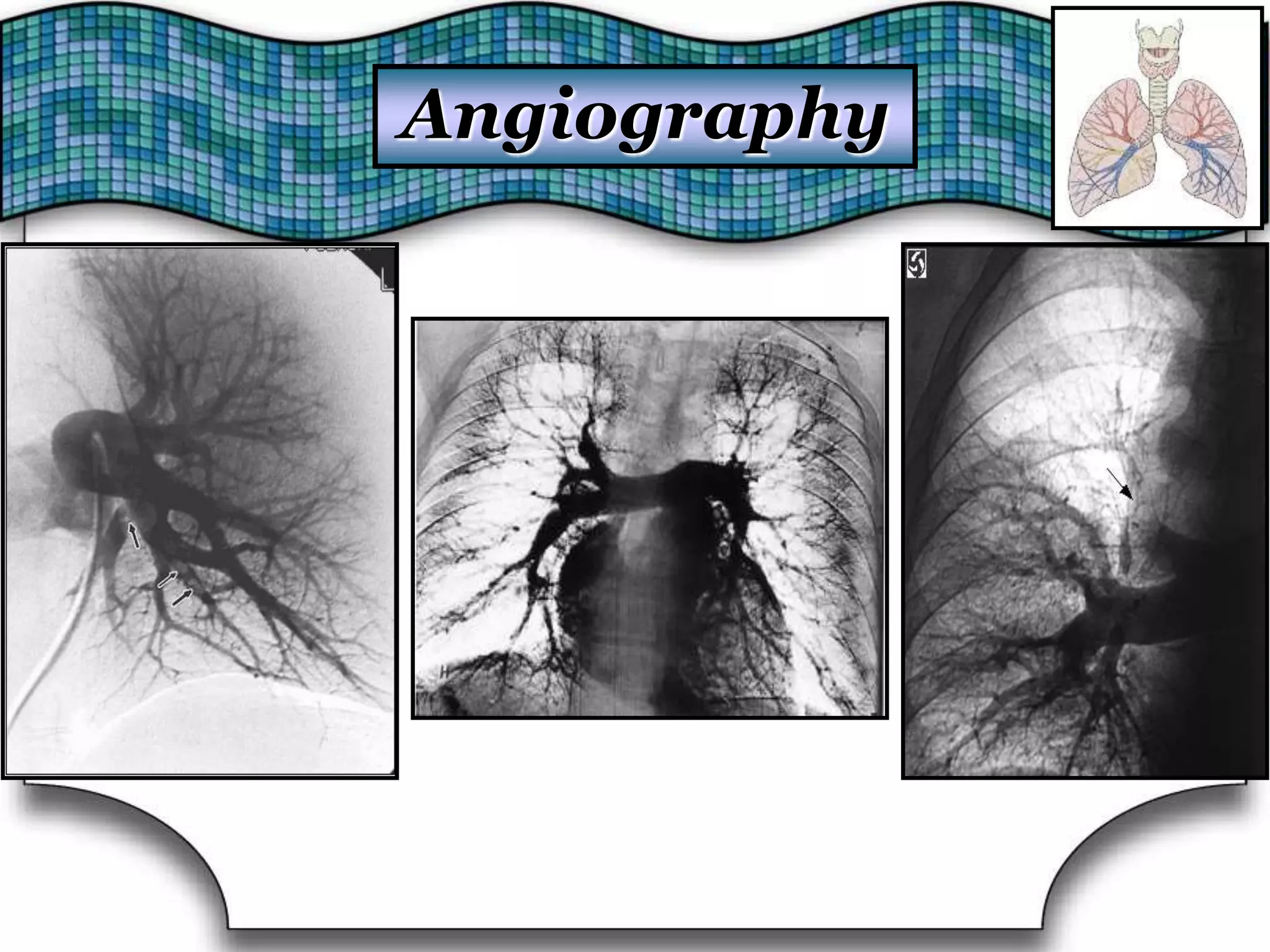 hemoptysispresentation.ppt