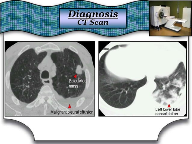 hemoptysispresentation.ppt