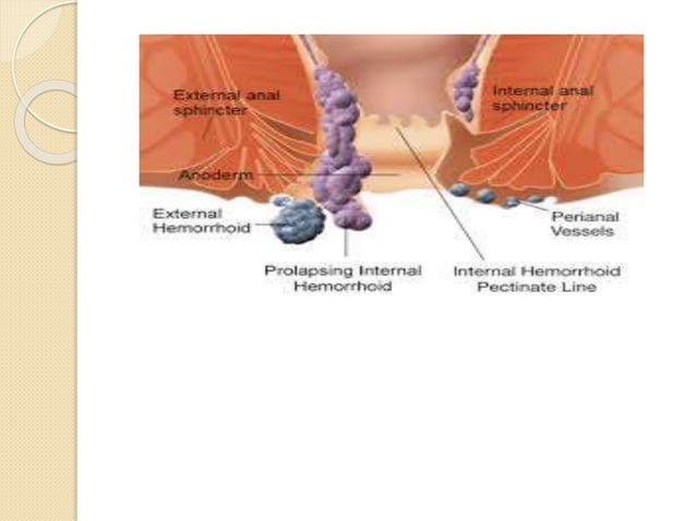 Hemoroid | PPTX