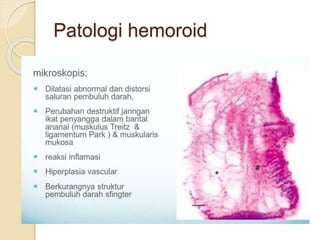 Hemoroid | PPTX