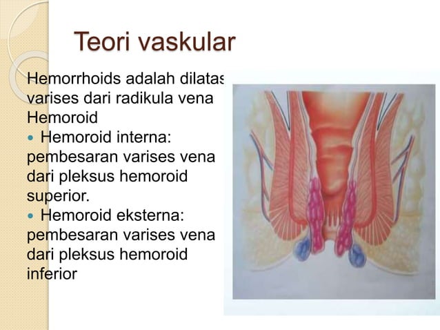 Hemoroid | PPTX