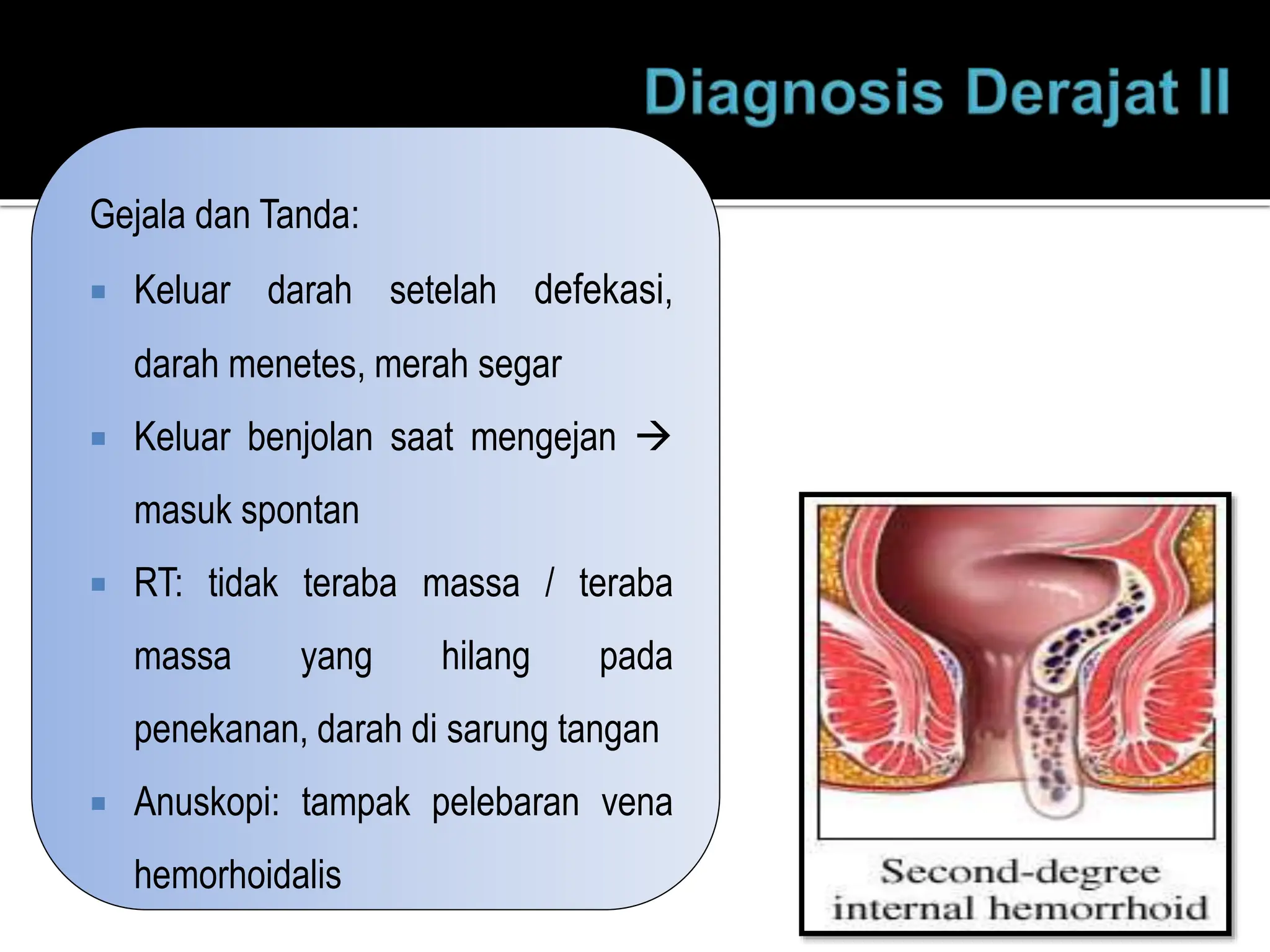 Hemoroid.ppt