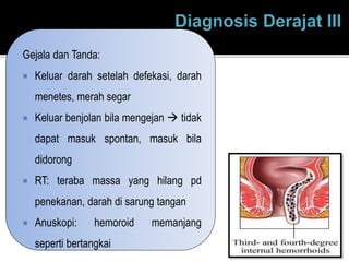 Hemoroid.ppt