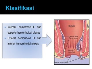 Hemoroid.ppt