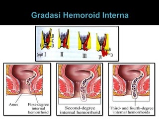 Hemoroid.ppt