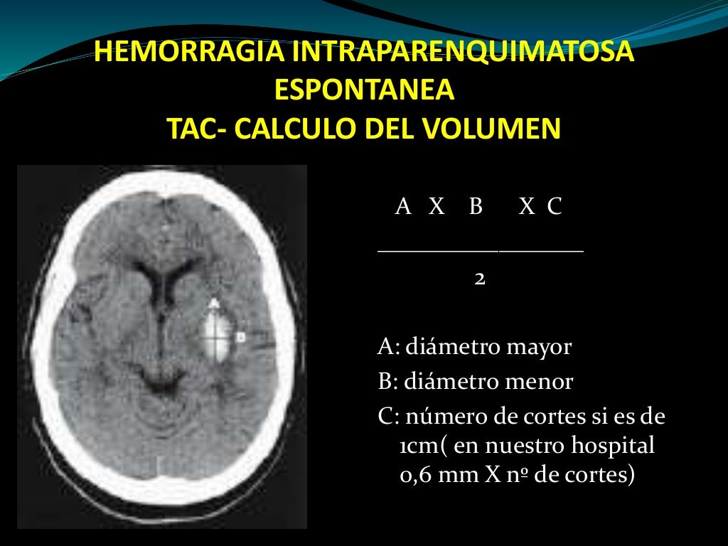 Hemorragia Cerebral Sintomas Tipos Intraparenquimatosa