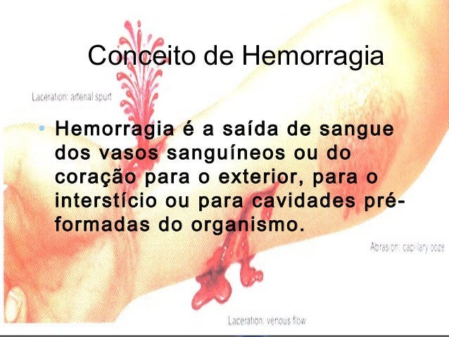 Hemorragia med7002 2004_2