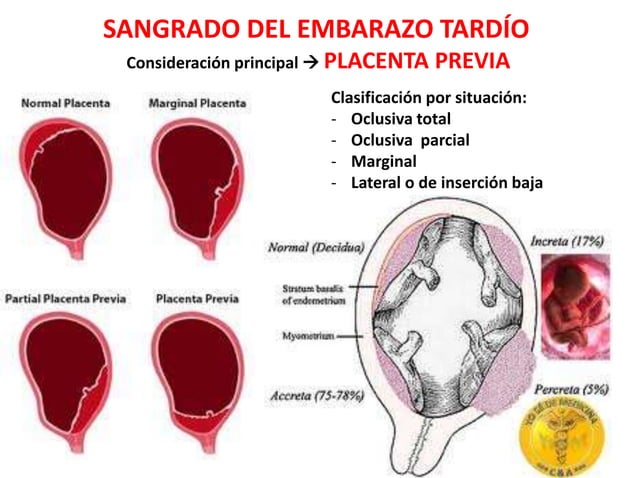 Hemorragia obstétrica