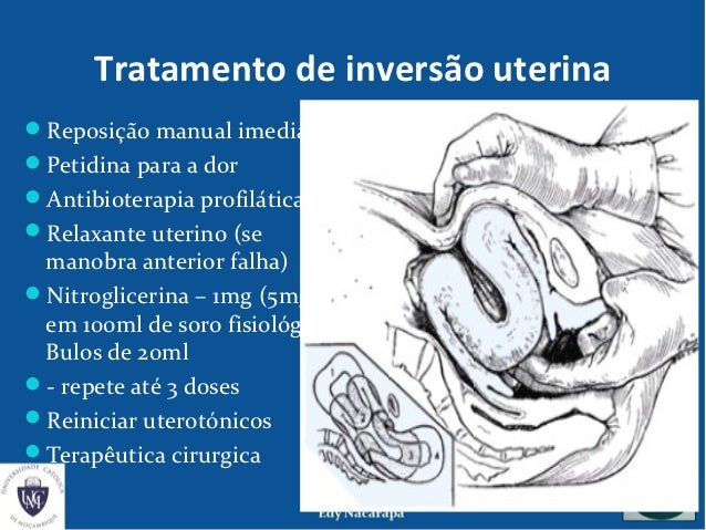 Hemorragia pos parto