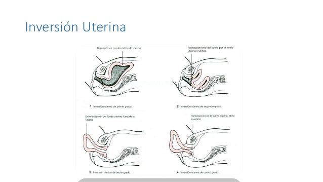 Hemorragia post parto - Atonia Uterina